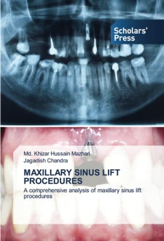 MAXILLARY SINUS LIFT PROCEDURES: A comprehensive analysis of maxillary ...