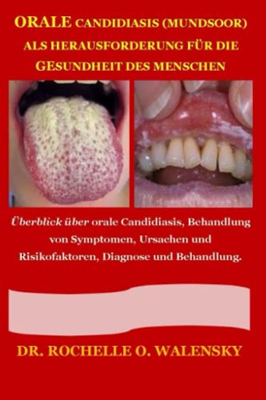 ORALE CANDIDIASIS (MUNDSOOR) ALS HERAUSFORDERUNG FÜR DIE GESUNDHEIT DES ...